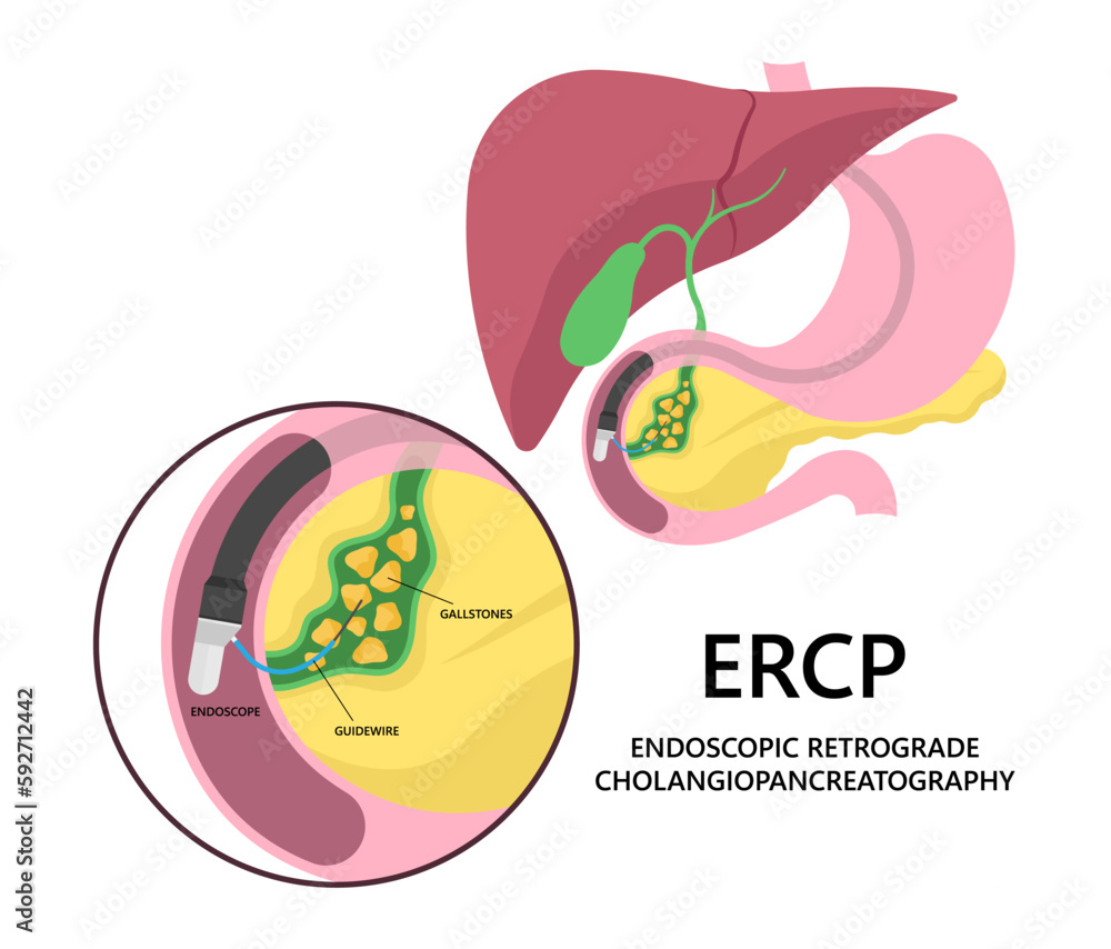 choledocholithiasis Endoscopic Retrograde Cholangiopancreatography ERCP Common stone Gallstones ...