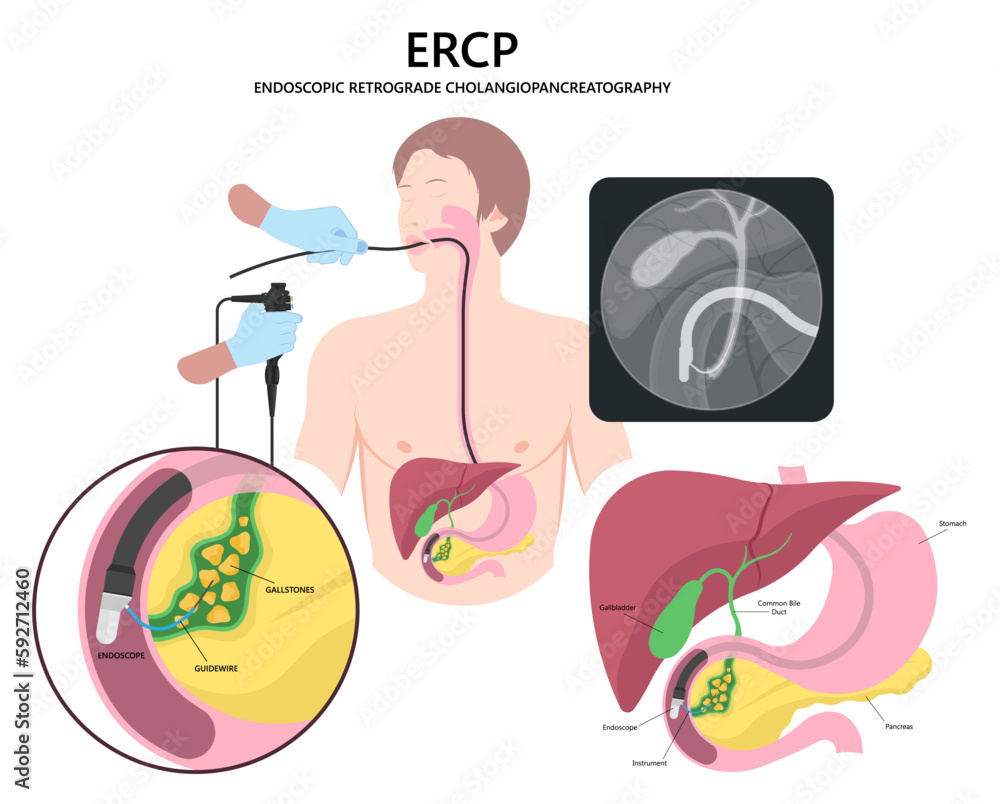 Endoscopic Retrograde Cholangiopancreatography Gallbladder Cholangitis Gallstones