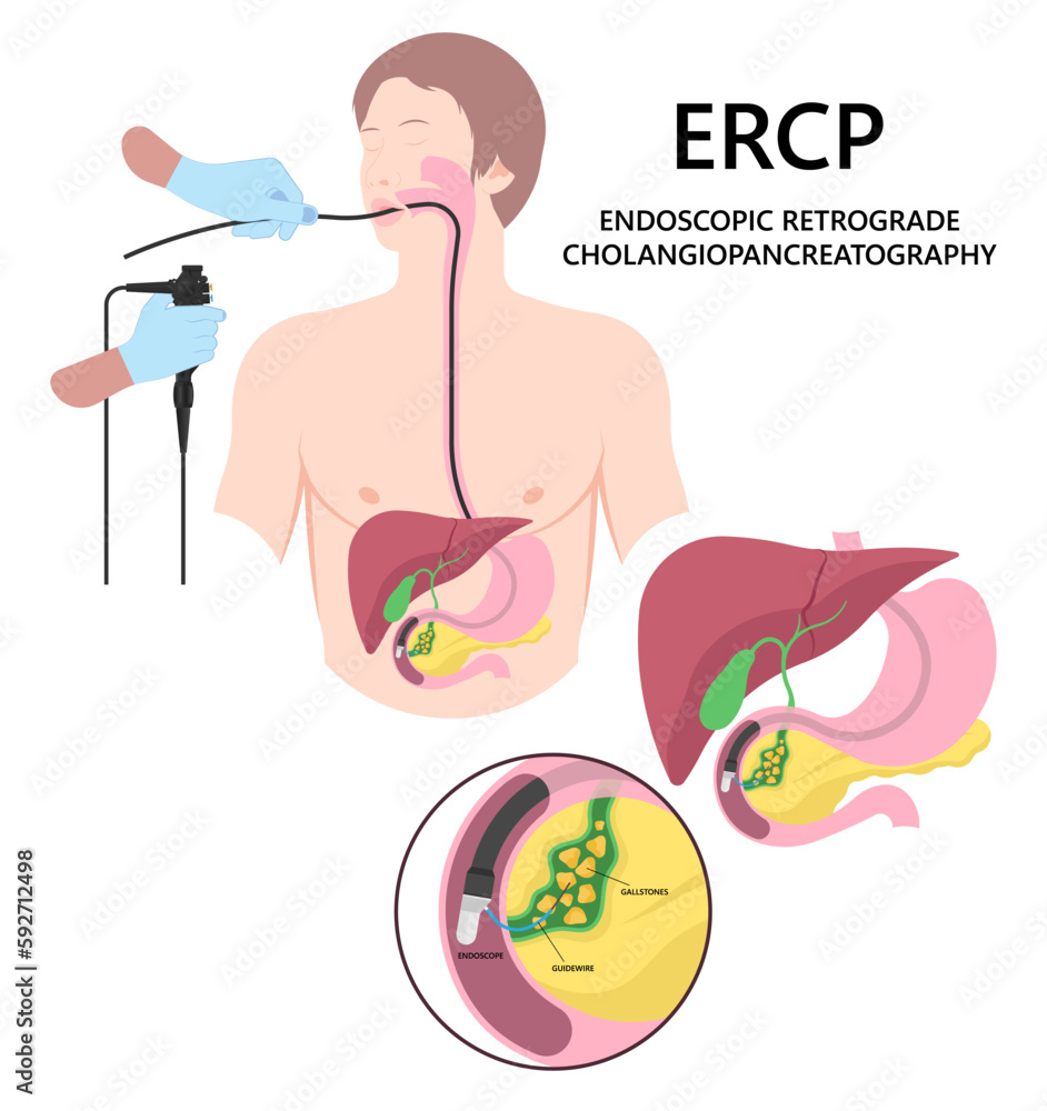 gallbladder Gallstones choledocholithiasis Endoscopic Retrograde ...