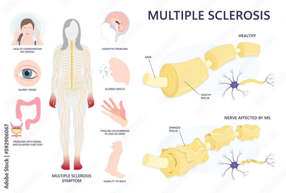 Parkinson's disease with multiple sclerosis Amyotrophic lateral or demyelinating myelitis and ...