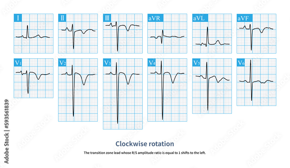 An electrocardiogram of a patient with pulmonary embolism showed that ...
