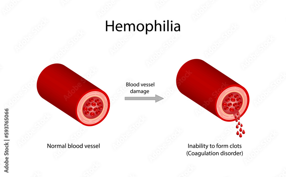 Vector de Stock Hemophilia, a bleeding disorder that slows the blood clotting. Haemophilia ...