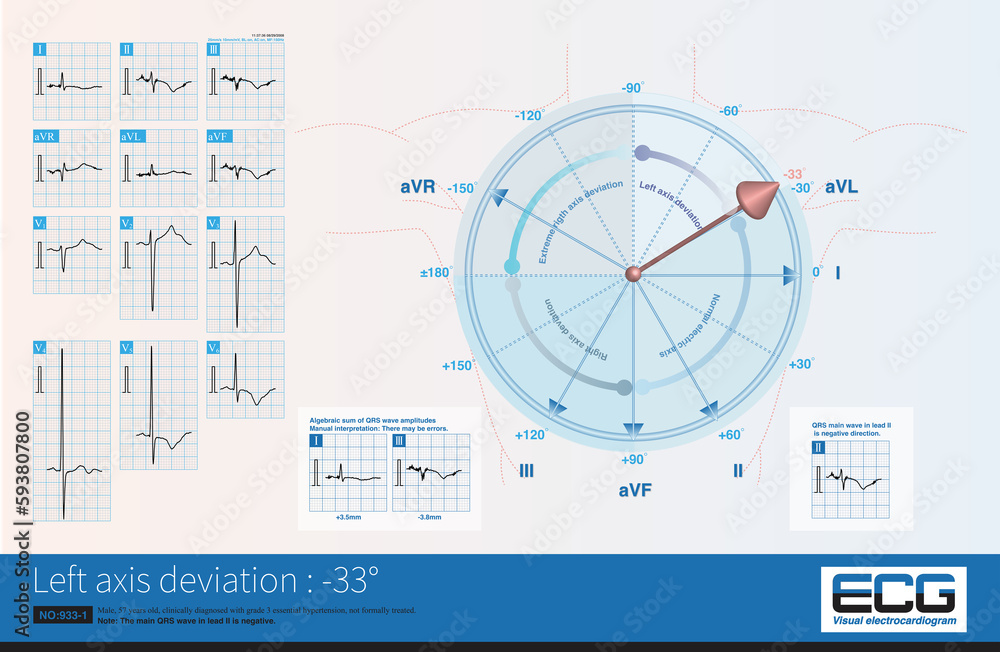 In clinical practice, left ventricular hypertrophy is a common cause of ...