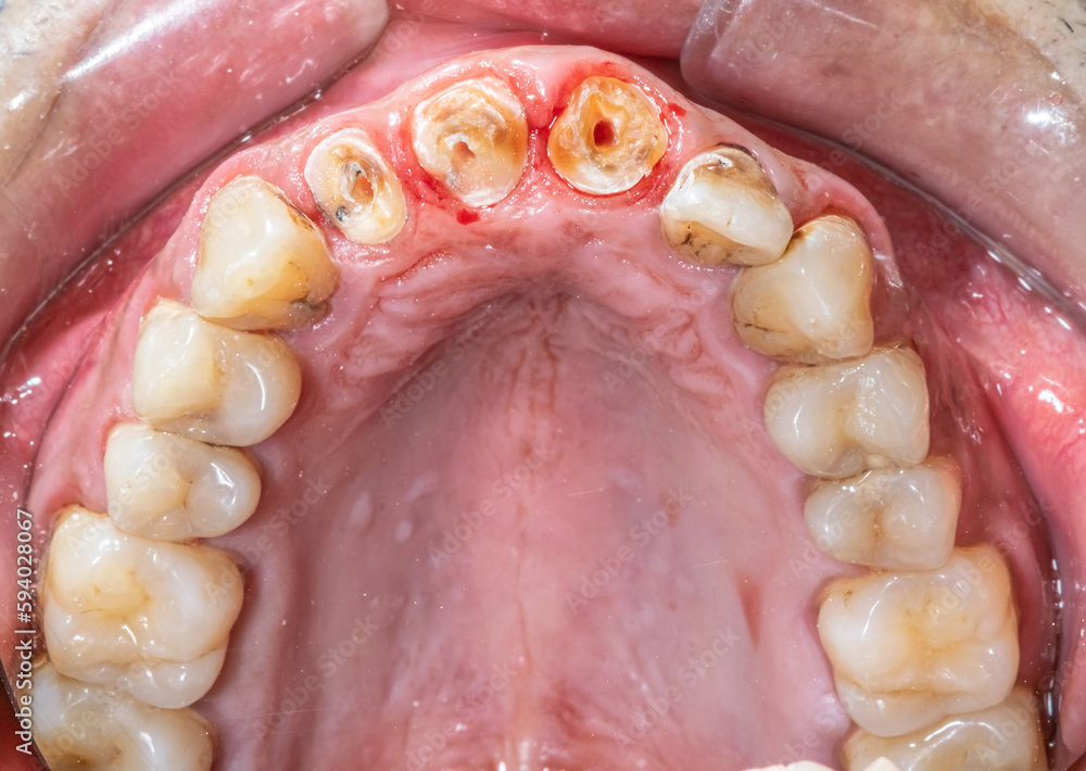 Occlusal view of maxillary arch with unhealthy gingival gum, decayed ...