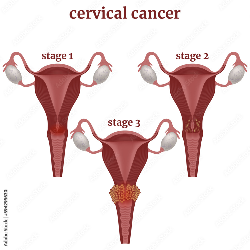 Medical poster. Stages of cervical cancer. Female reproductive system ...