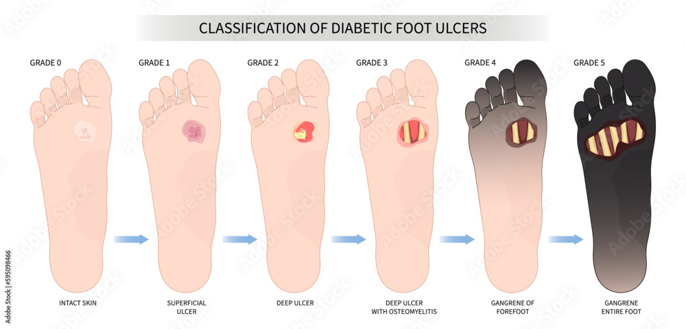 Стоковое векторное изображение «Diabetic foot or diabetes gangrene ...