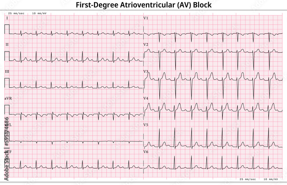 ECG First Degree Atrioventricular Block - 1st degree AV Block - 12 Lead ...