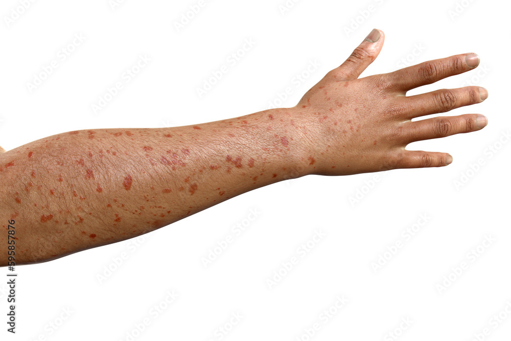 Stock-Illustration „A skin rash on the arm of a patient with Marburg ...