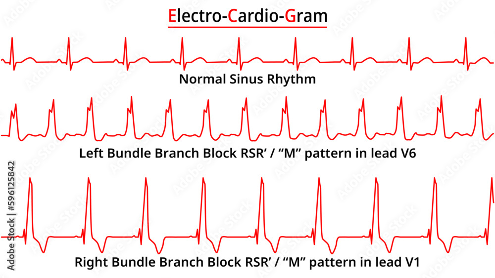 Set of ECG Common Abnormalities - Left Bundle Branch Block vs Right ... Set of ECG Common Abnormalities - Left Bundle Branch Block vs Right ...