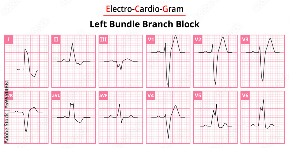 Left Bundle Branch Block - The Differences in ECG Waveform for Each of ...