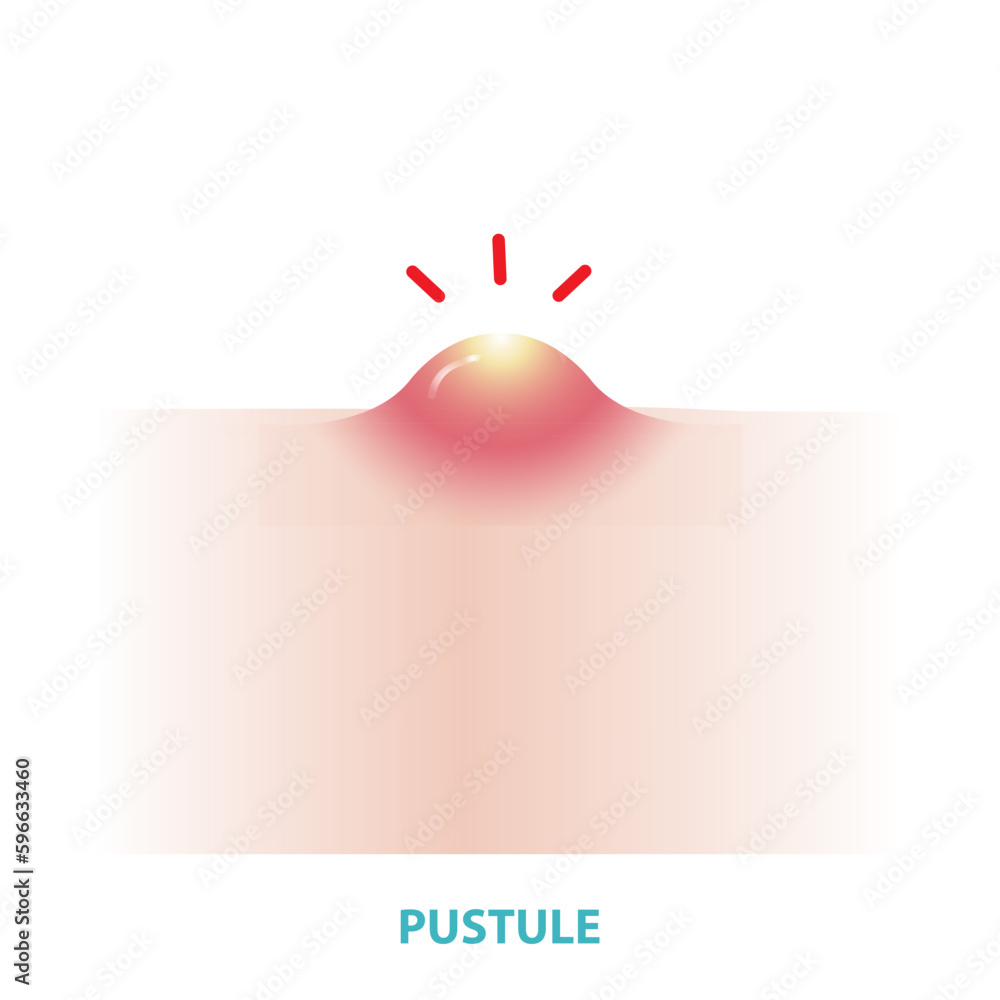 Pustule acne vector isolated on white background. Formation of ...