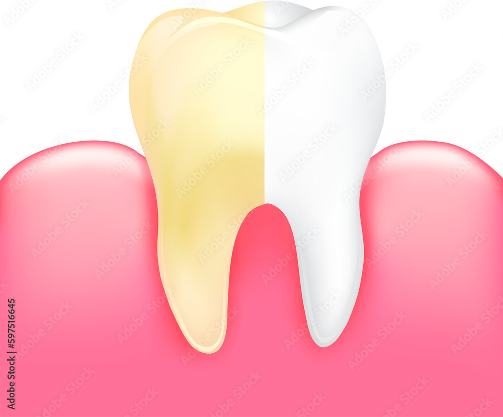 Dental veneer, tooth before and after. dental care concept. Stomatology ...
