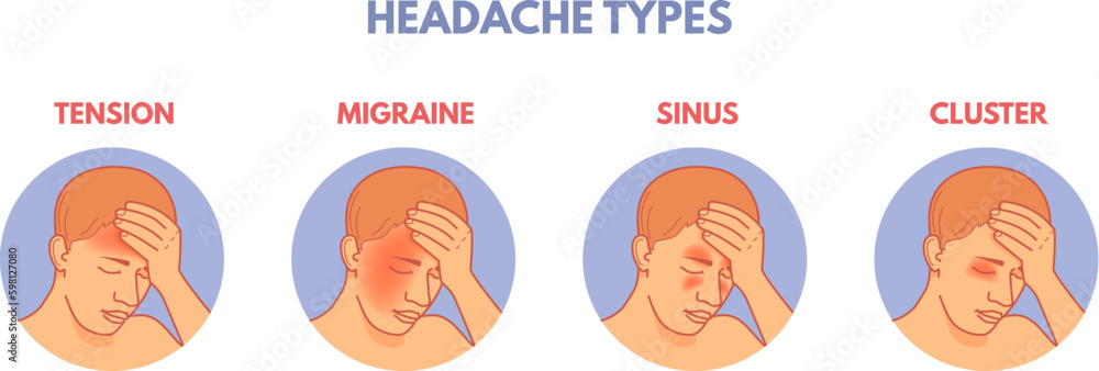 Stock-Vektorgrafik „Headache types. Headaches areas infographic diagram ...