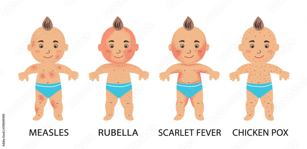 Infographics of childhood rash, measles, rubella, scarlet fever, varicella. Poster with a baby ...