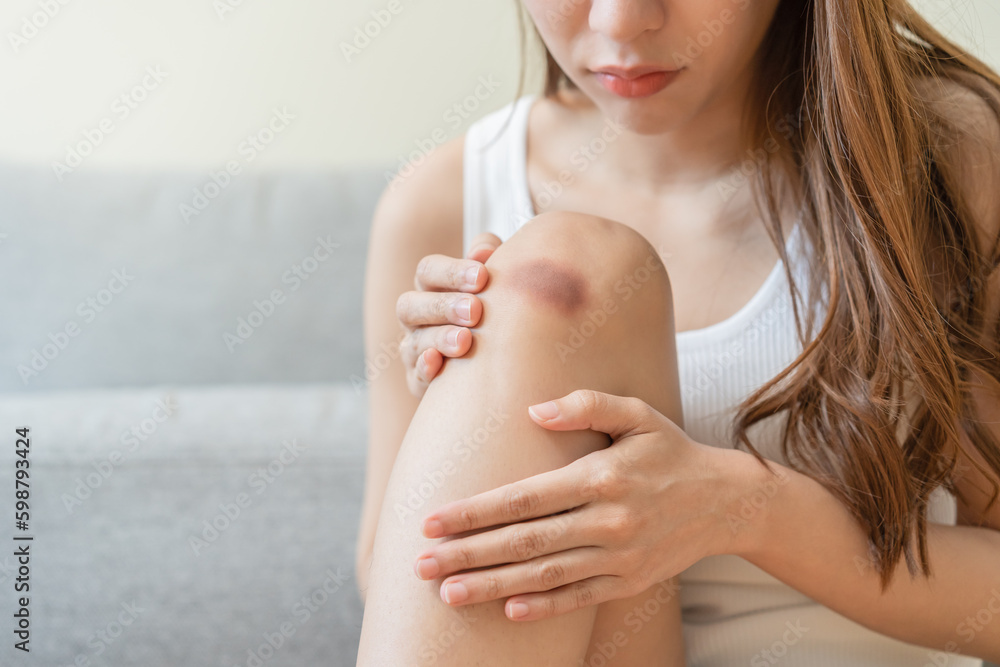 Close up of stain bruise wound on leg, contusion asian young woman ...
