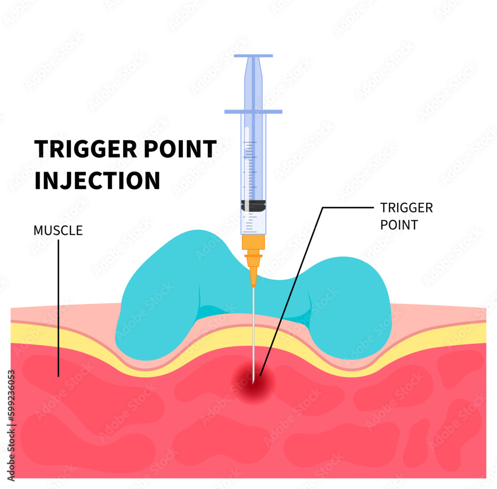 Image vectorielle Stock Fibromyalgia Gluteus Medius Pain Anatomy and ...