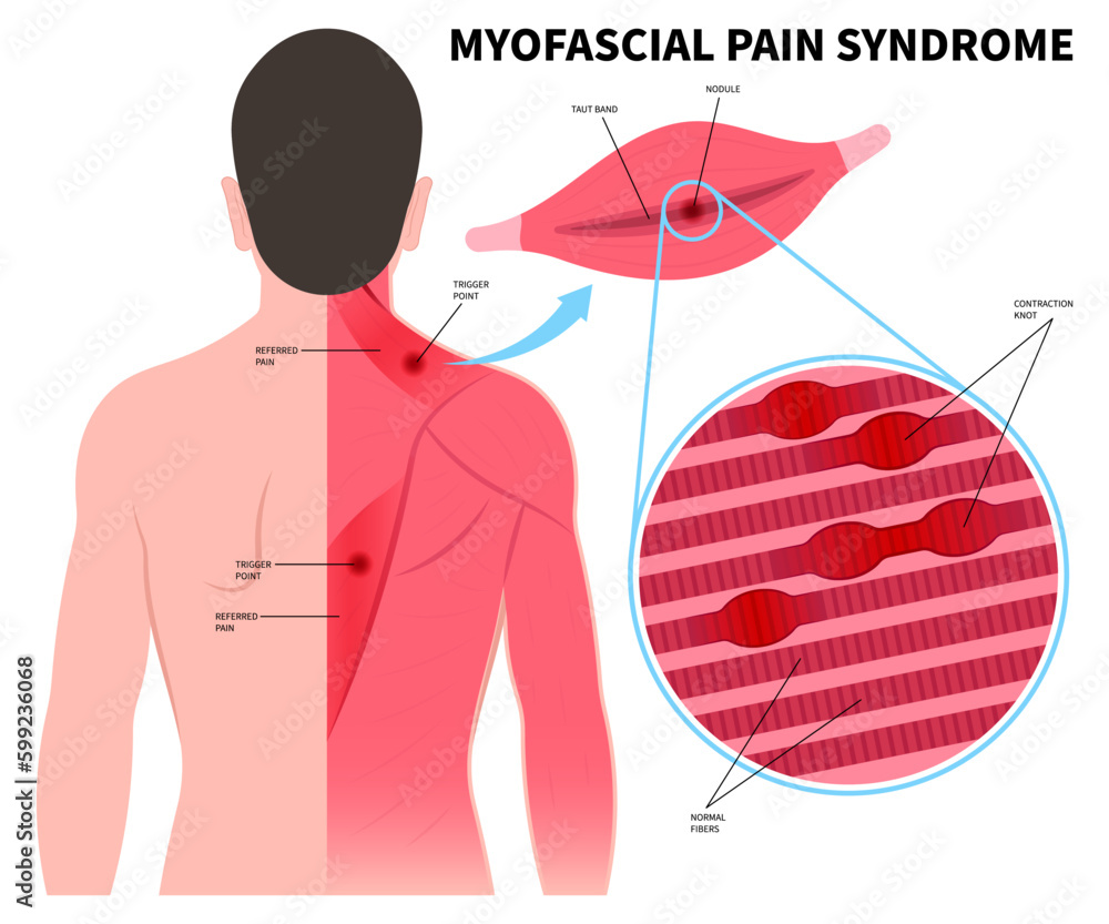 Vector de Stock Myofascial Pain Syndrome muscle trauma anatomy Trigger ...