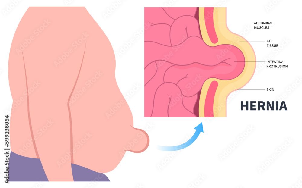 stomach abdominal pain small large intestine constipation belly button ...