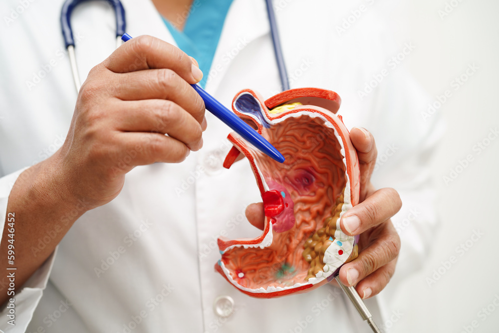 Stomach disease, doctor holding anatomy model for study diagnosis and ...