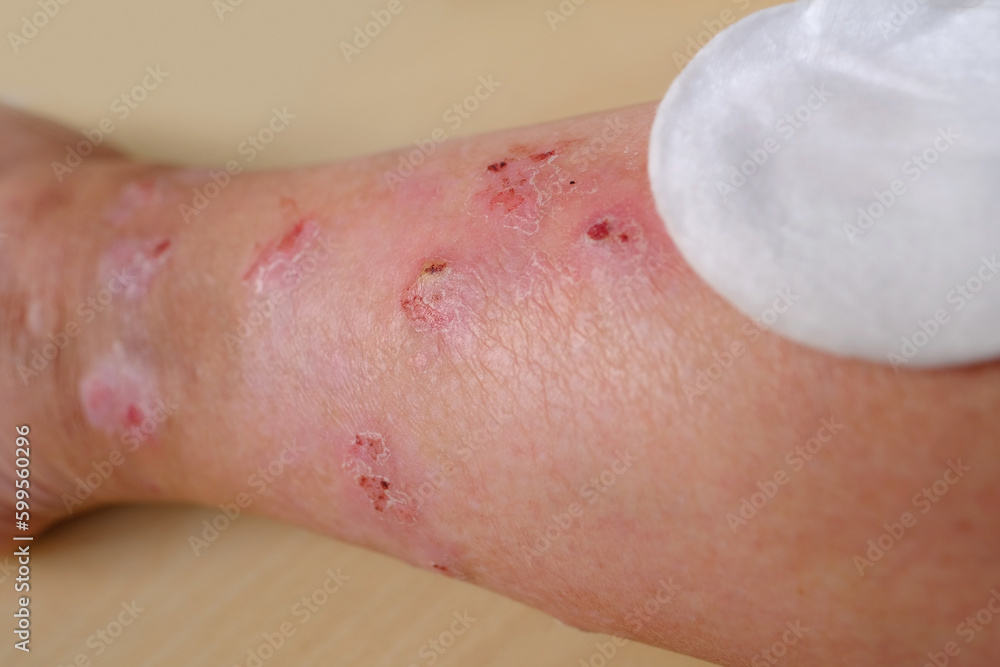 Stock-Foto „doctor treats weeping wounds, venous ulcers on female leg ...