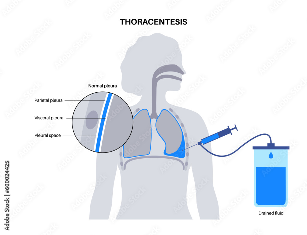 เวกเตอร์ Stock Thoracentesis medical procedure | Adobe Stock
