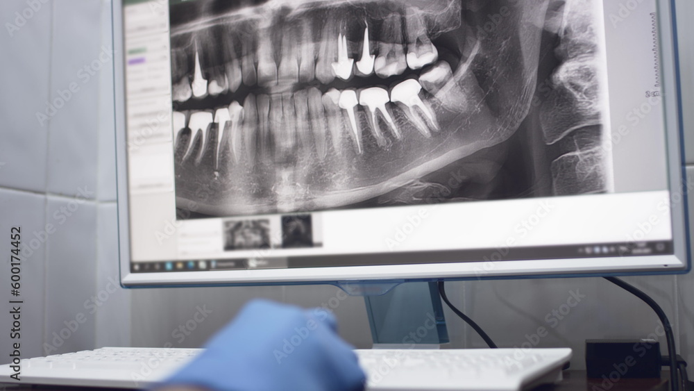 Dentist doctor examines a panoramic x-ray of the jaw on a computer ...