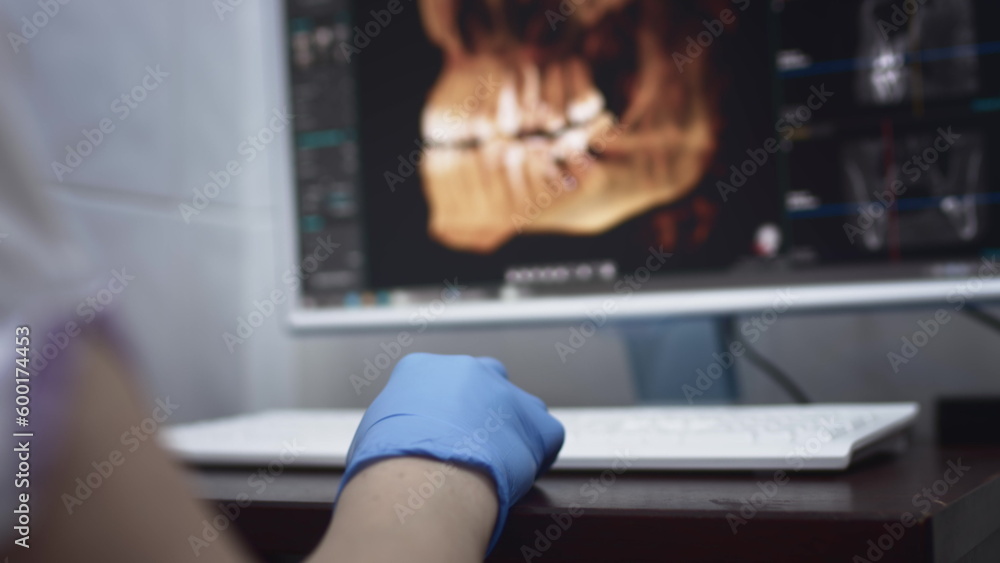 Dentist doctor examines a panoramic x-ray of the jaw on a computer ...