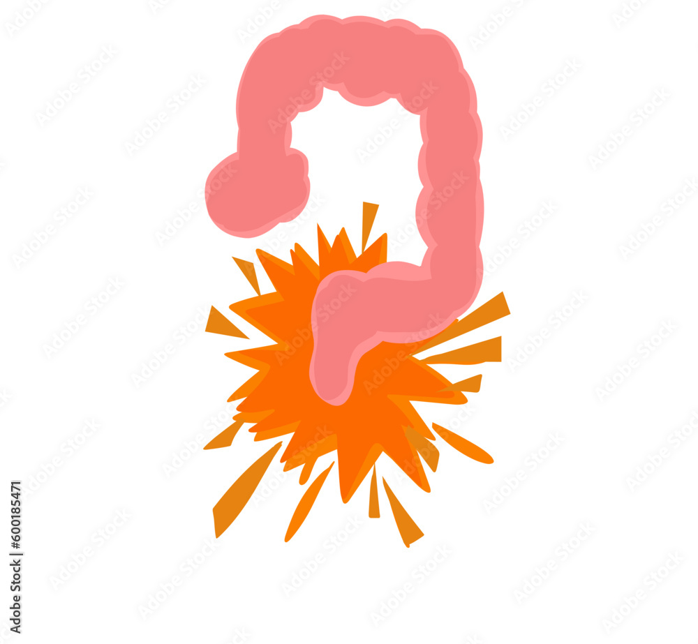 เวกเตอร์ Stock Ulcerative colitis concept. Inflammatory bowel disease ...