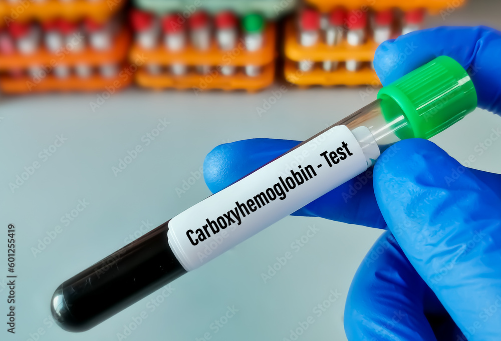 Medical Laboratory Scientist holding heparin plasma blood sample for ...