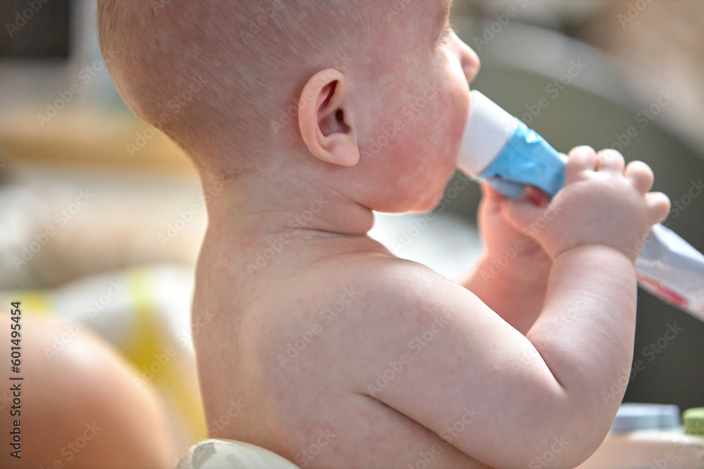 roseola rash a viral rash on the skin of a child Stock Photo | Adobe Stock