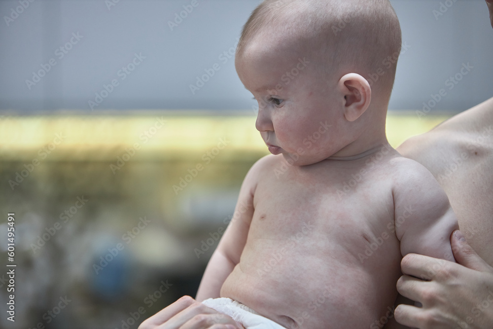 Foto de Stock roseola rash a viral rash on the skin of a child | Adobe ...