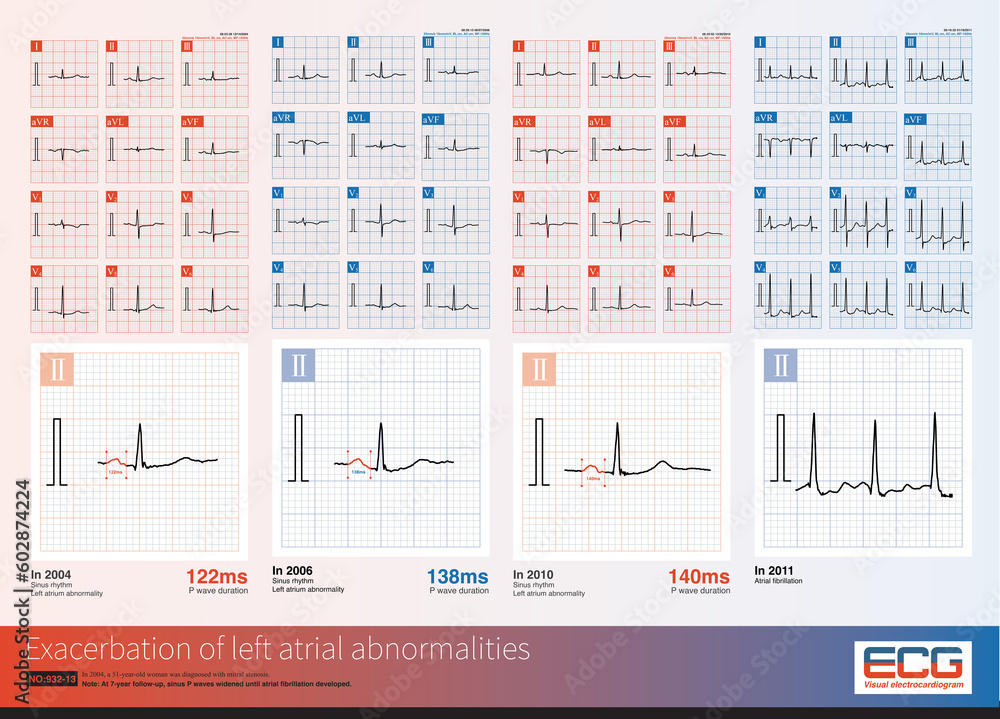 In 2004, a 51-year-old woman was diagnosed with mitral stenosis, and ...