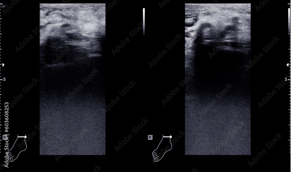 Color Doppler ultrasound determination in deep vein thrombosis patients ...