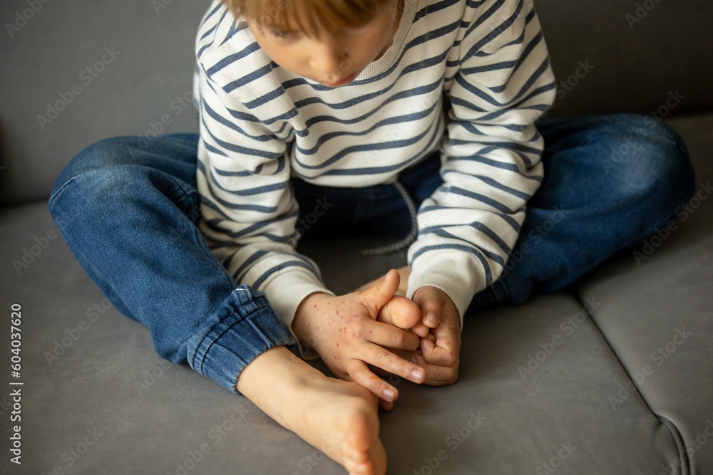 Child with skin rash, roseola. Hand-foot-and-mouth disease. Enterovirus ...