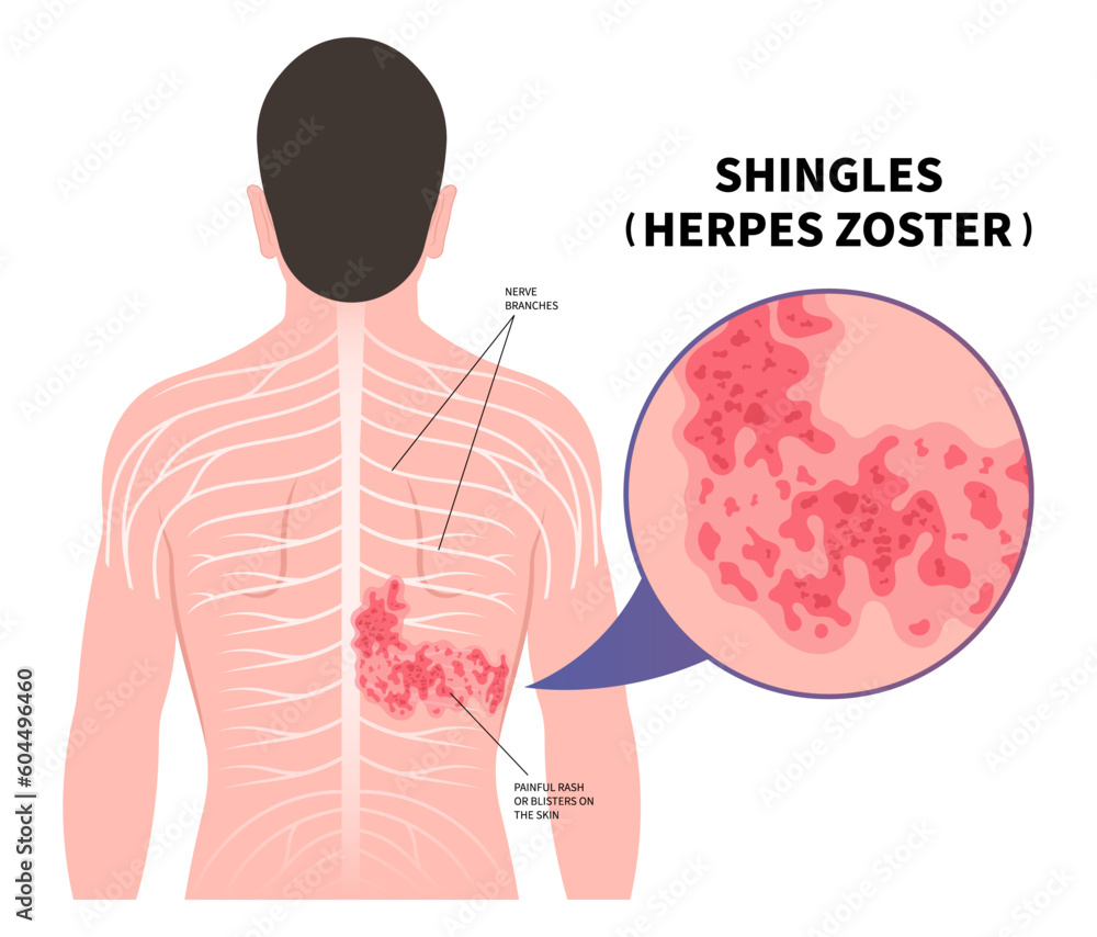 Shingles Herpes Zoster virus on body and skin itching rash blister sores of varicella chickenpox ...