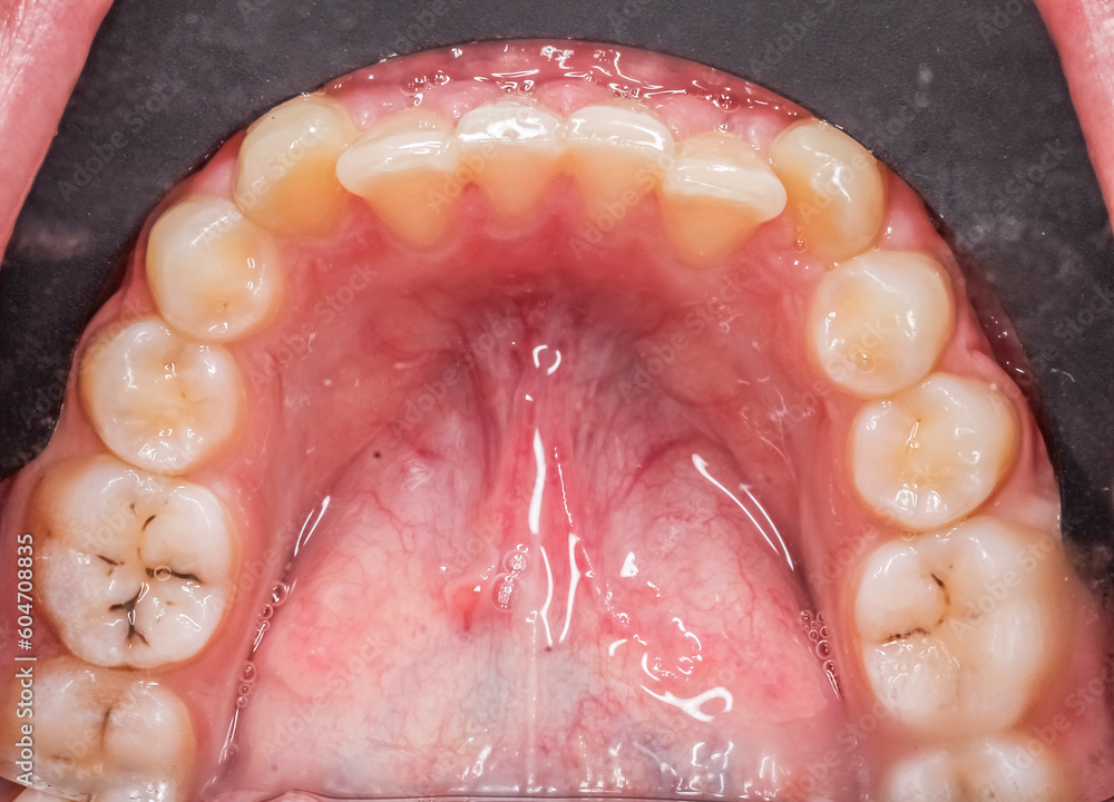 Dentistry case with crooked anterior teeth and molar caries. Lip ...