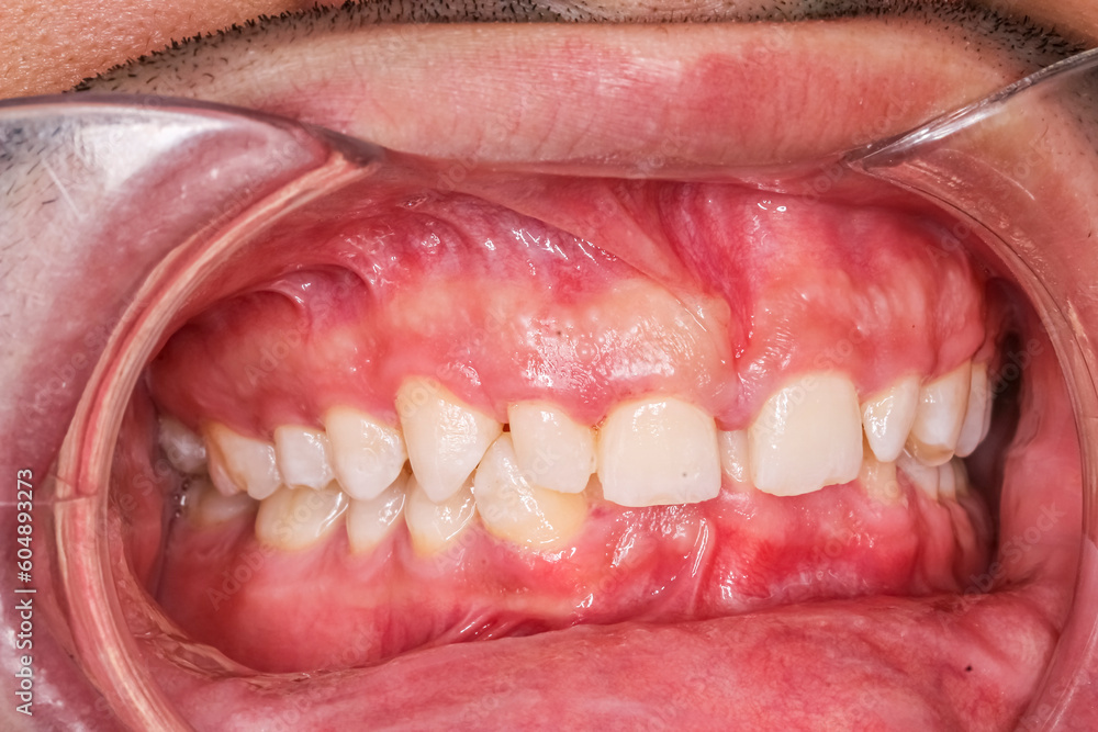 Dental orthodontics patient, oblique side view of maxillary and ...