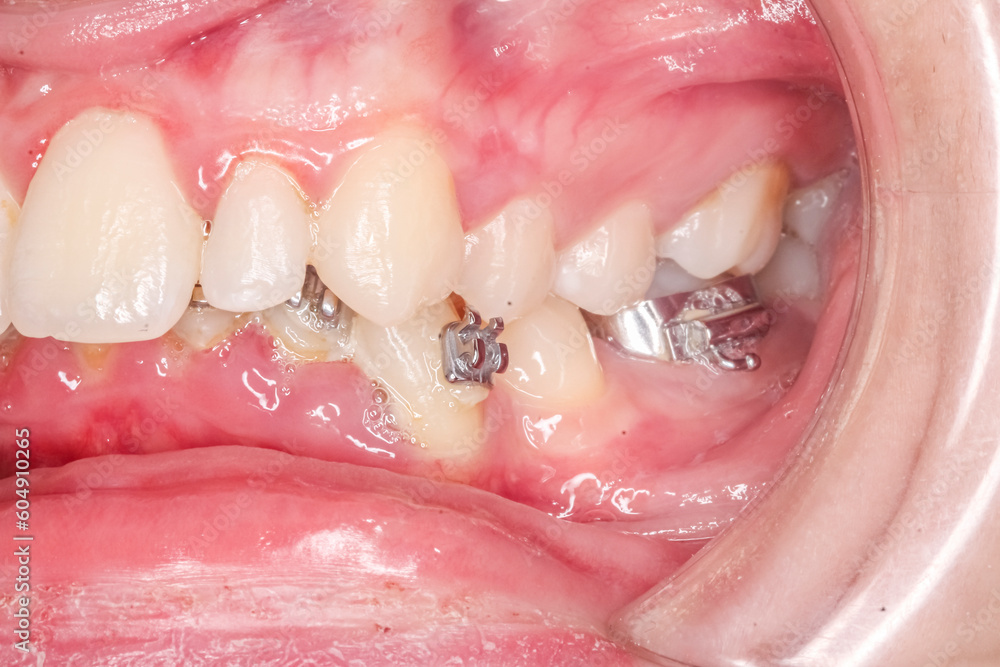 Frontal view of dental maxillary and mandibular arches in occlusion ...