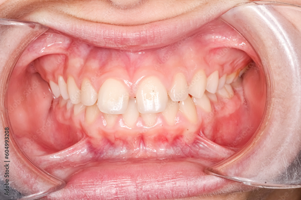 Frontal view of dental maxillary and mandibular arches in occlusion ...