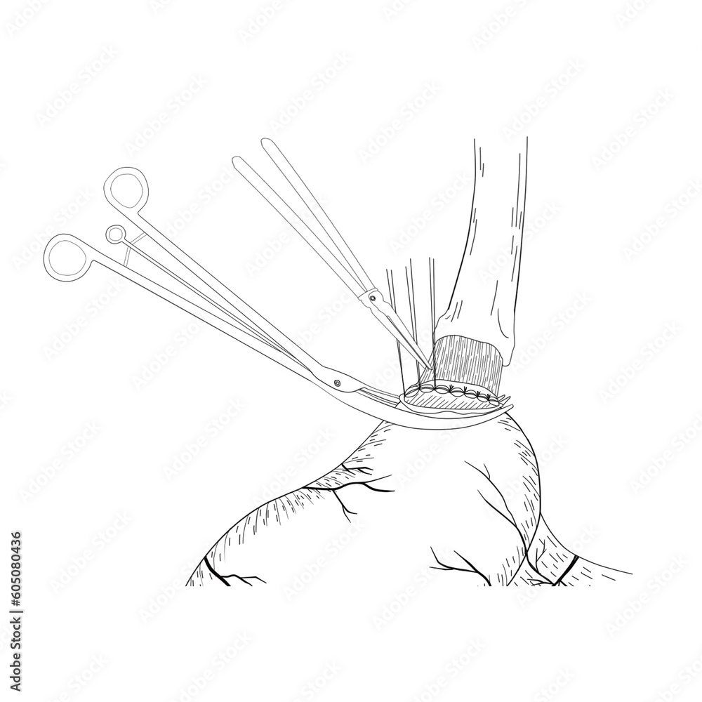 Gastroesophageal anastomosis surgery.This medical illustration shows ...