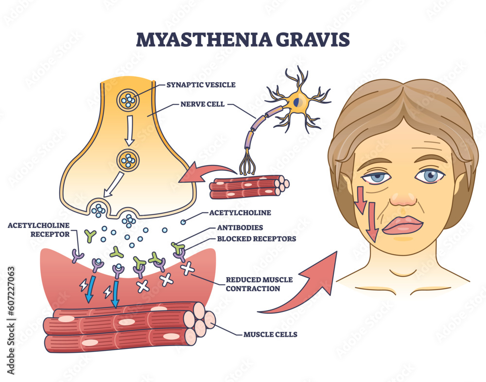 Stock-Vektorgrafik „Myasthenia gravis as autoimmune, neuromuscular ...
