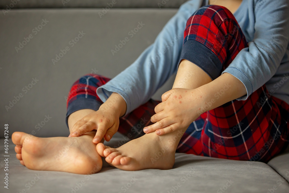 Child with skin rash, roseola. Hand-foot-and-mouth disease. Enterovirus ...