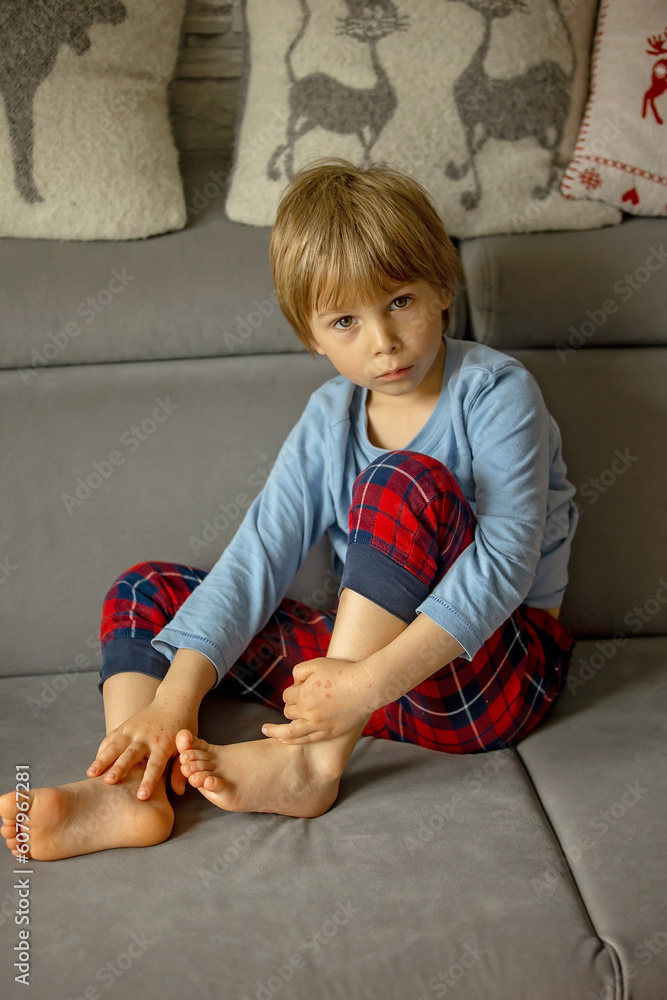 Child with skin rash, roseola. Hand-foot-and-mouth disease. Enterovirus ...