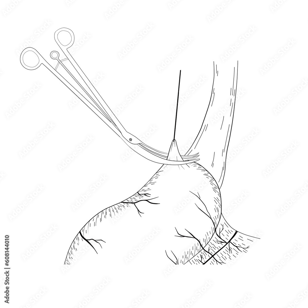Stock-Illustration „Gastroesophageal anastomosis surgery.This medical ...