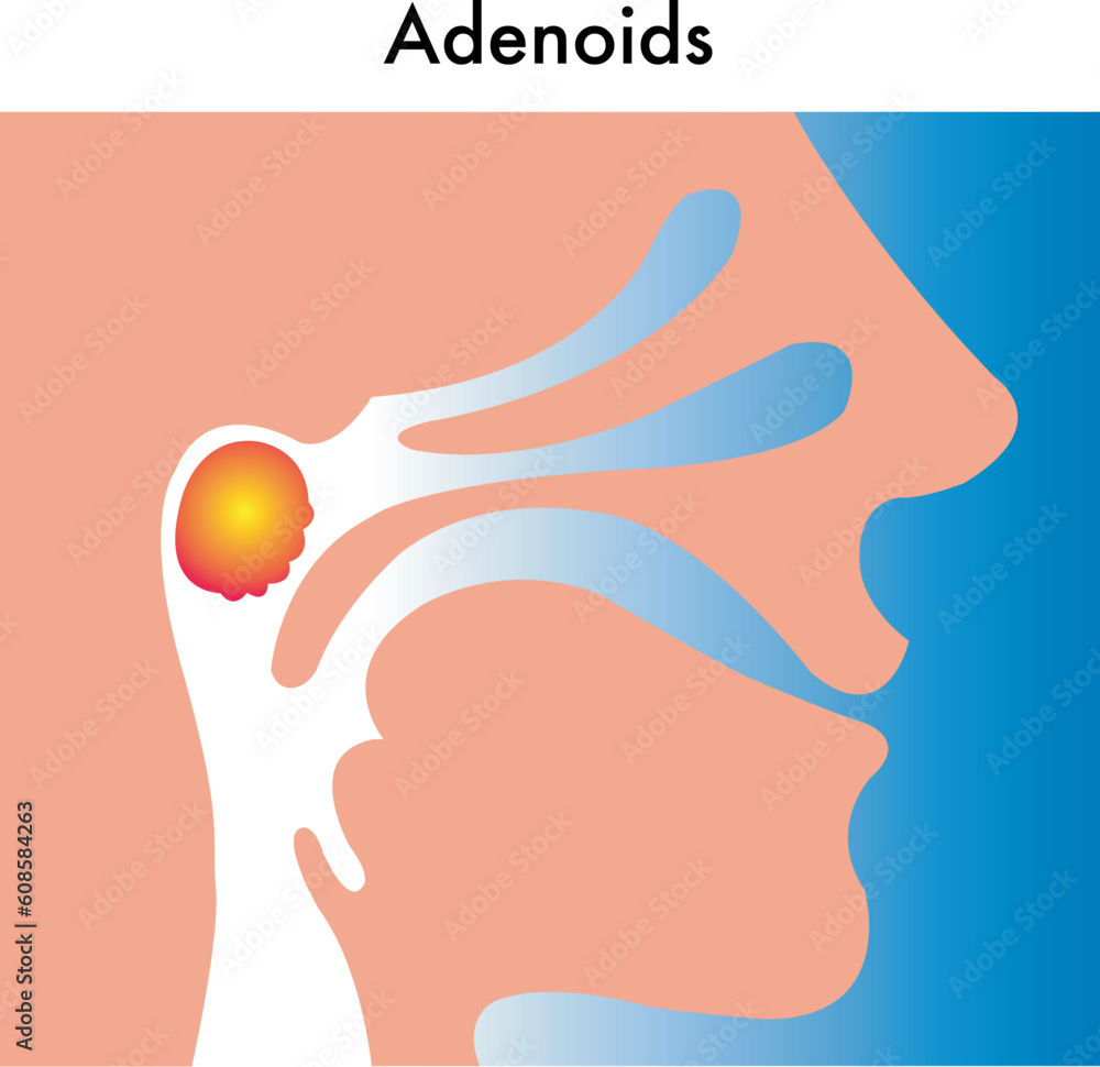 simbolic illustration of the adenoids Stock Vector | Adobe Stock