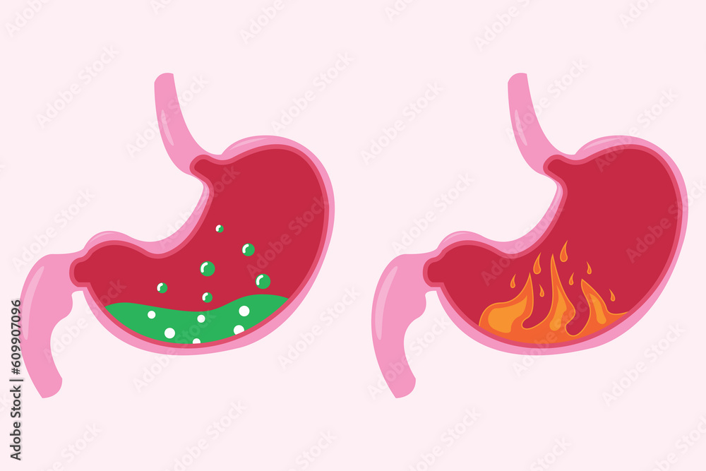 Stomach icon set, cartoon vector illustration. cross section of normal ...