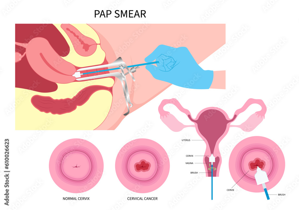 Cervix Cancer And Examine In Women Female With Obstetric Swab Vulvar 9261