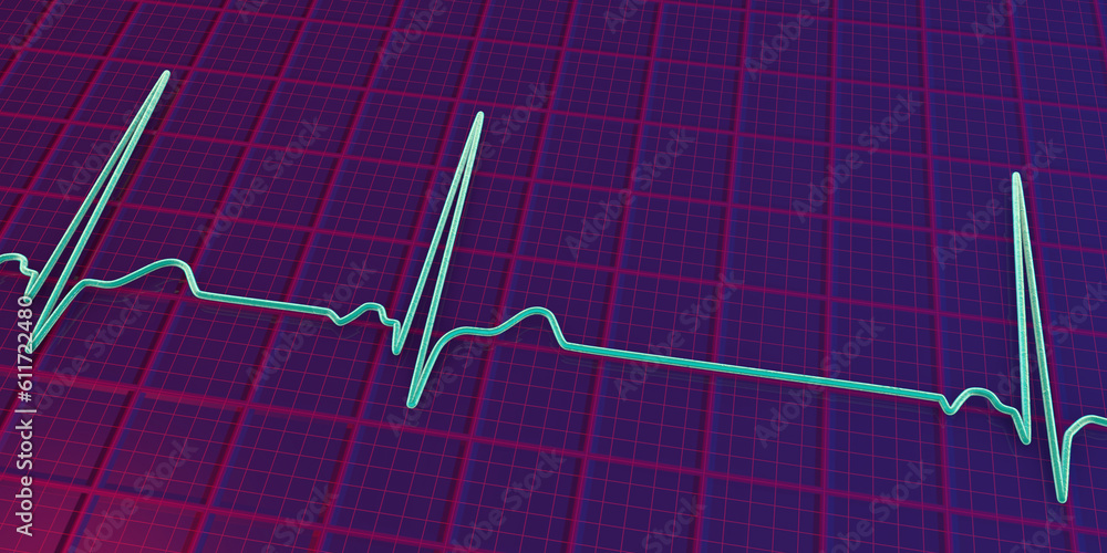 Electrocardiogram ECG displaying sinus arrhythmia, 3D illustration ...