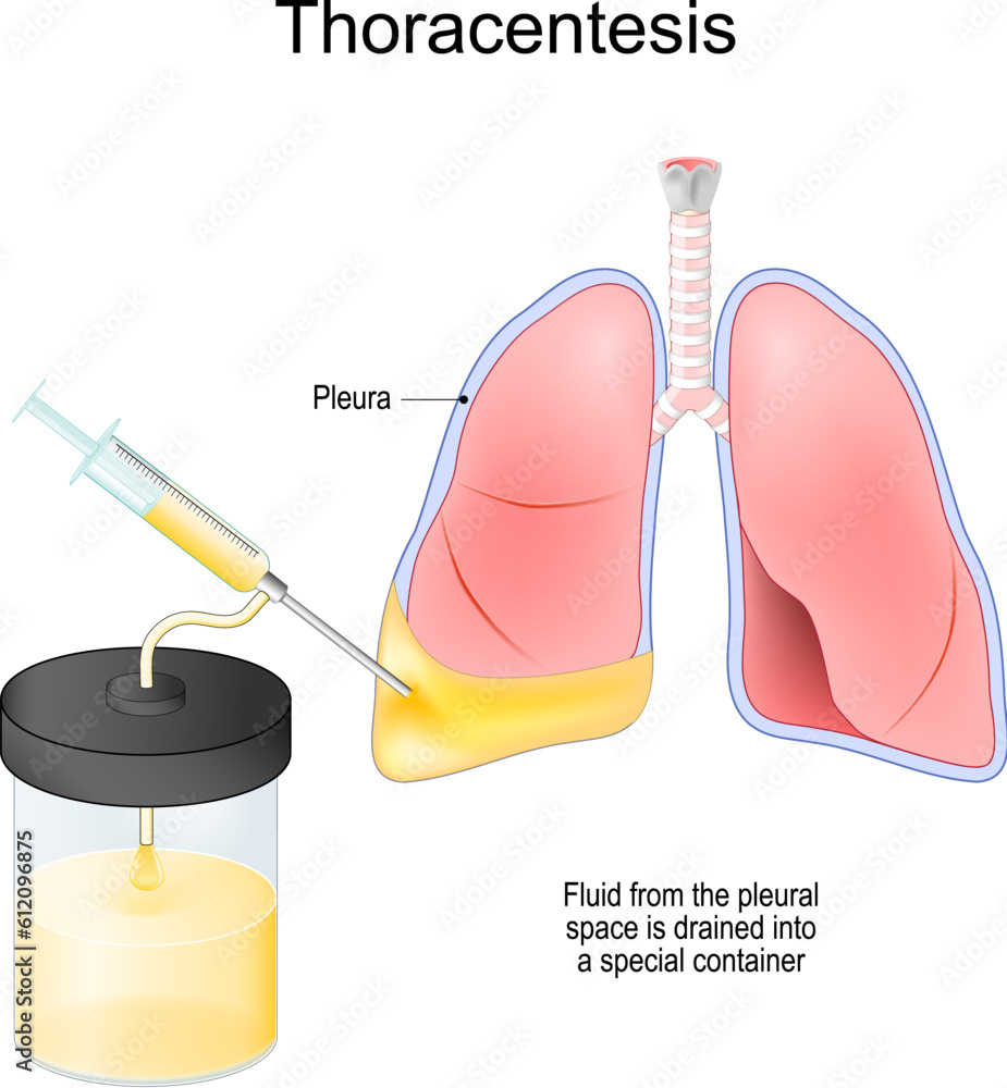 Thoracentesis. Thoracocentesis is an invasive medical procedure Stock ...