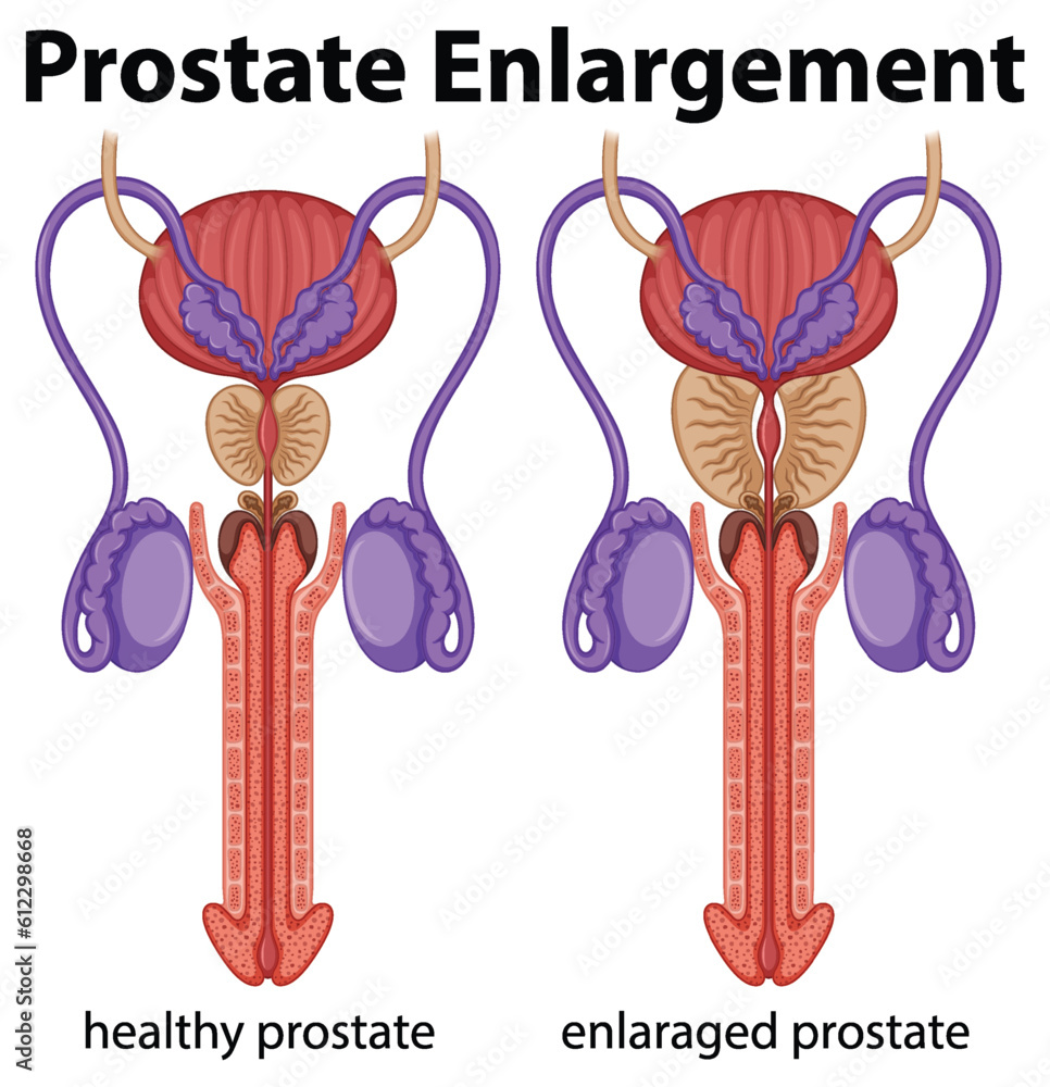 Inside the male reproductive system with prostate enlargement Stock ...